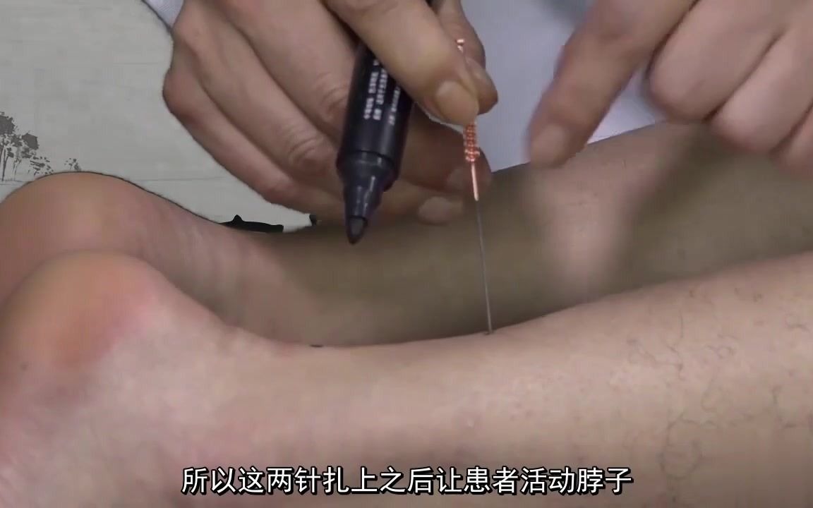 周志军:董氏奇穴针灸治疗落枕