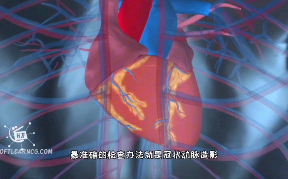 如何检查冠心病严重程度,冠状动脉造影术过程,3D演示。