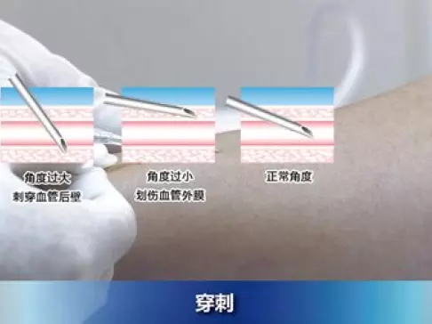 静脉留置针输液操作流程视频