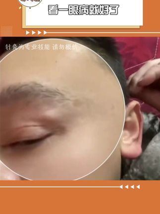 当针拔出来那一刻 我感觉病已经好了 #针灸 #中医 #万万没想到