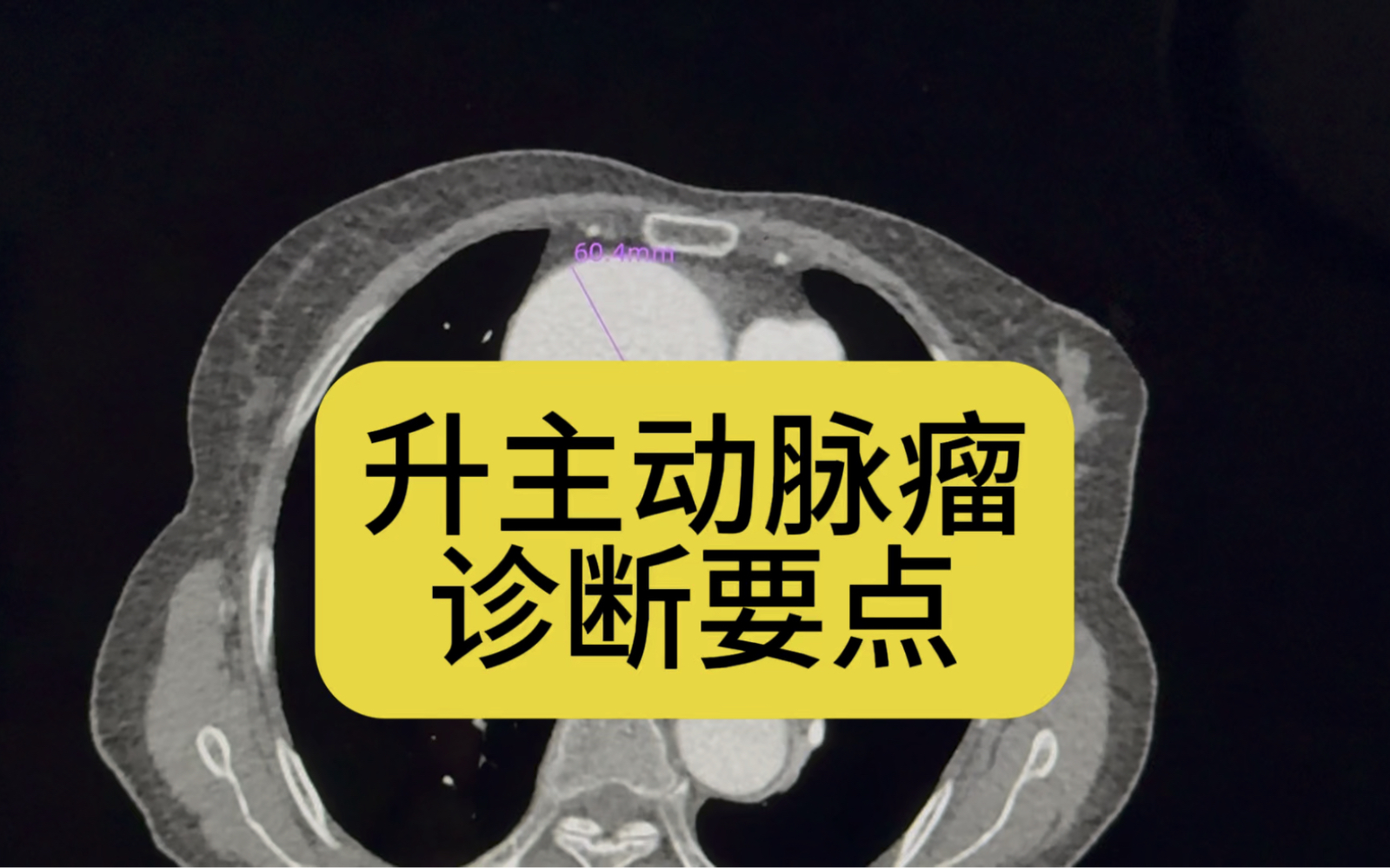 升主动脉瘤的影像学表现