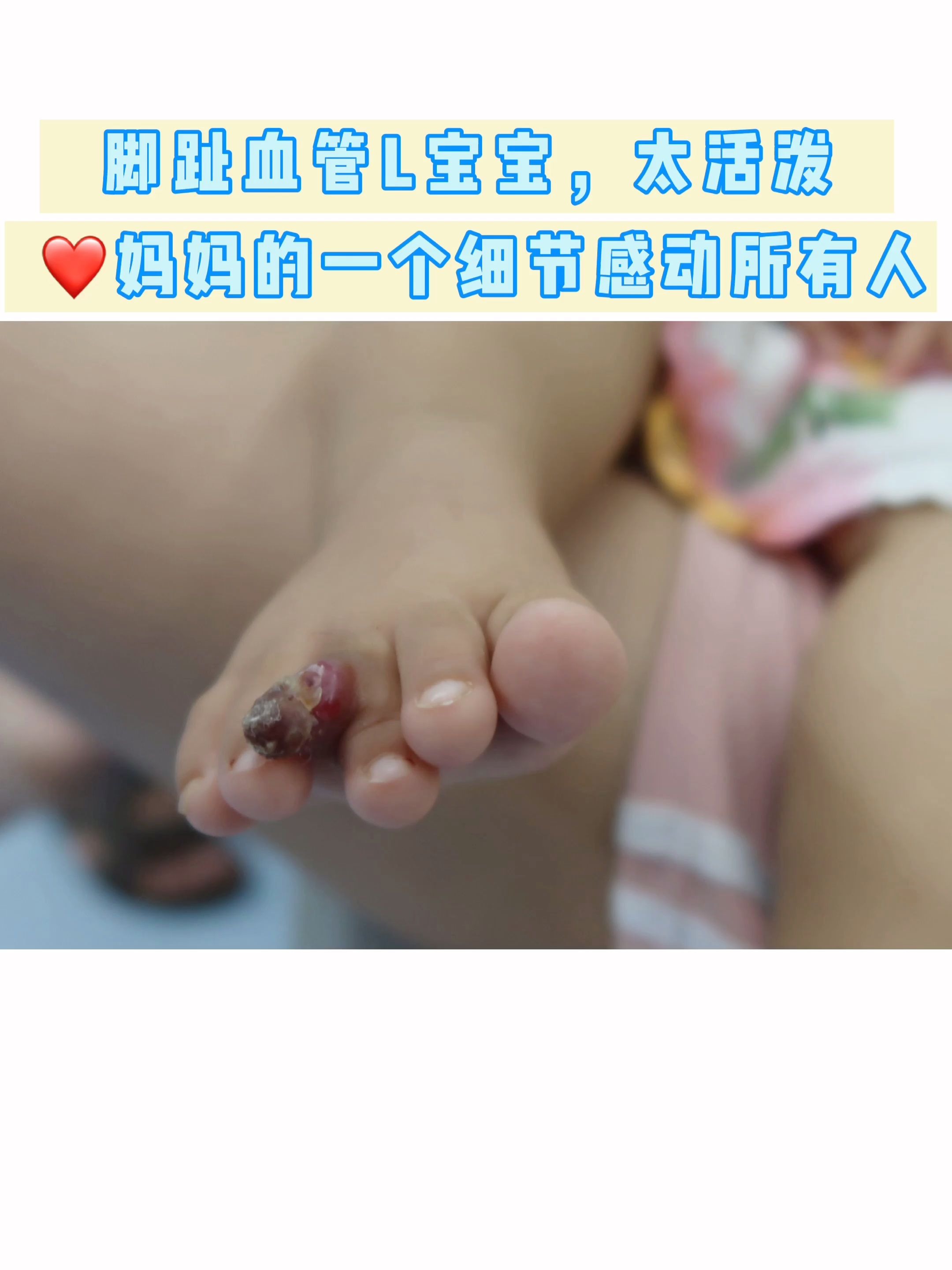 血管瘤论坛义诊肖静与脚趾(疣状)宝宝互动《百度搜血管瘤论坛》