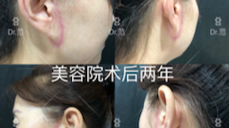 SMAS悬吊提升术后3个月 VS 美容院假“拉皮”术后2年切口 SMAS...