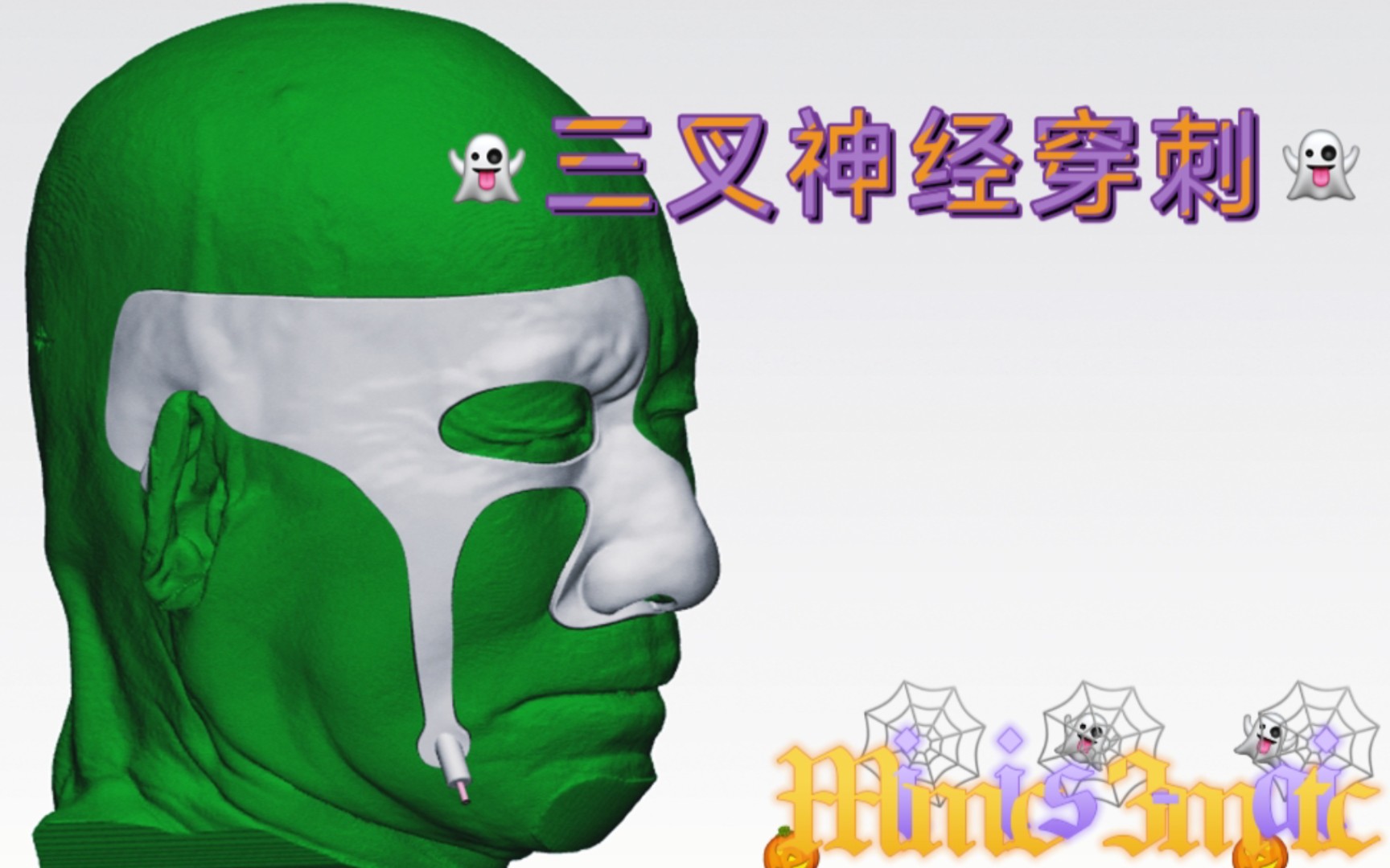 利用Mimics.3-matic等软件制作三叉神经穿刺路径设计的猜想