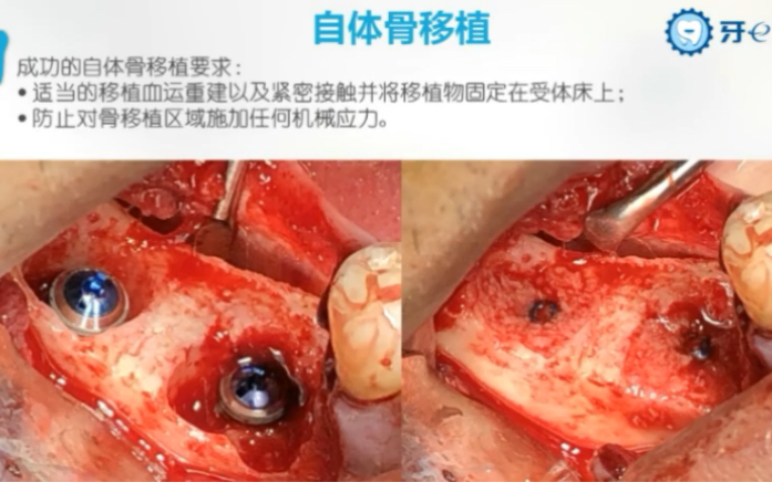 种植新人启航系列课《GBR引导骨再生术上》——冯楠