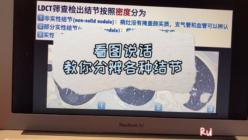 唐大夫放大招了!你们要的磨玻璃,原来长这个样子!涨知识了!
