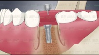 30秒了解种植牙全过程,快来围观!种植牙动画视频