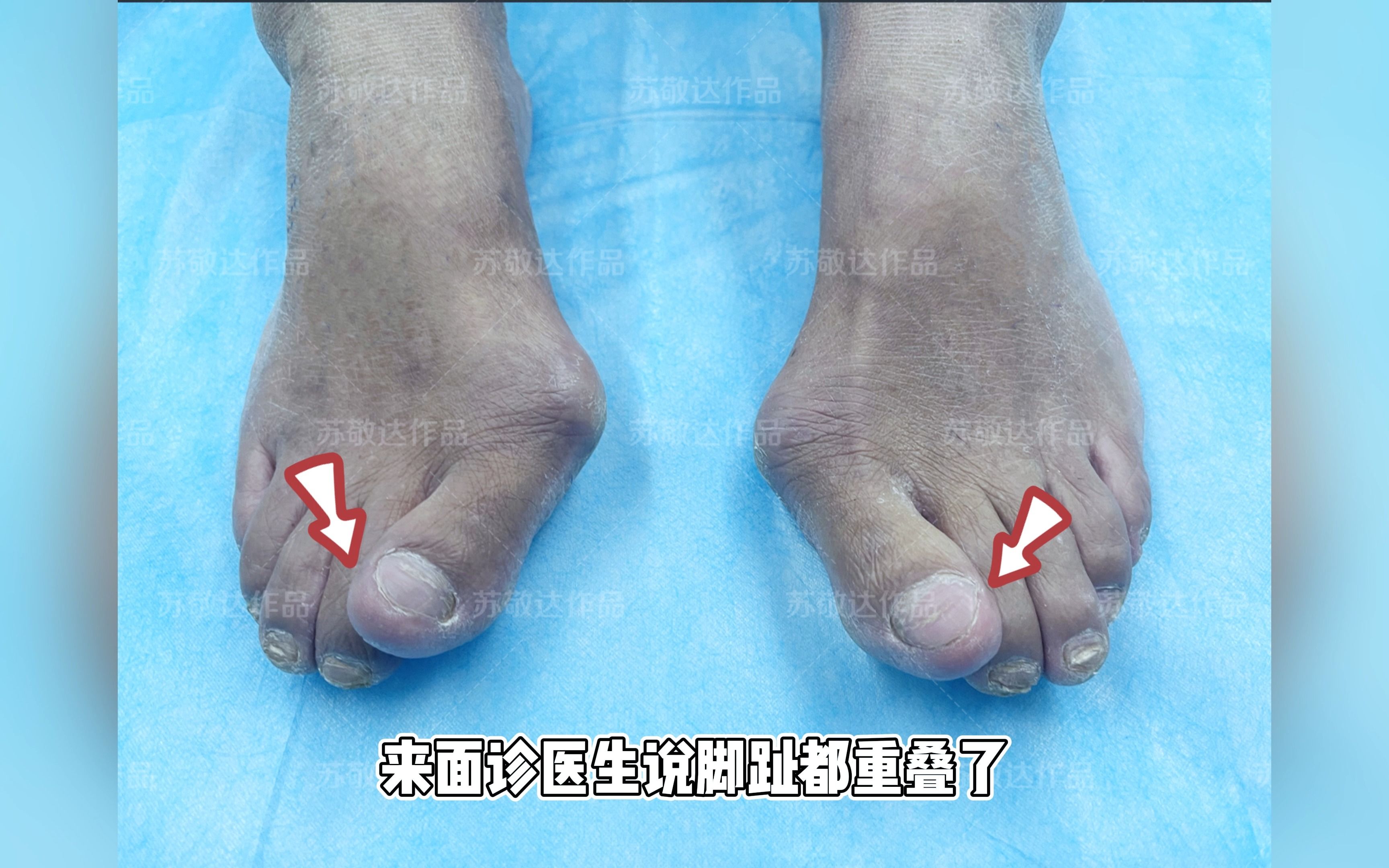 【苏敬达】40岁河南大哥来手术,重度拇外翻,脚趾重叠