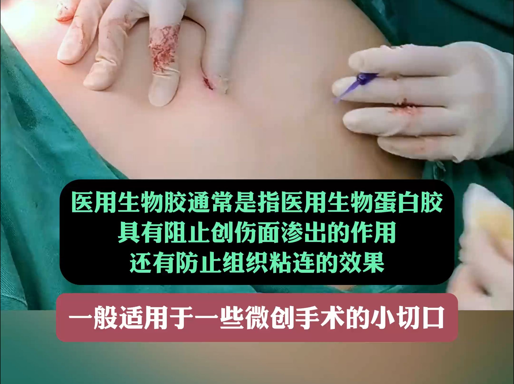 医用生物胶粘合伤口,术后不用拆线