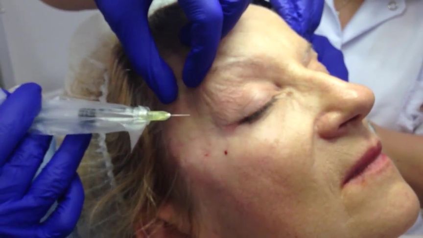 老奶奶为了美,忍疼打了几针美容针,果然皮肤嫩了不少