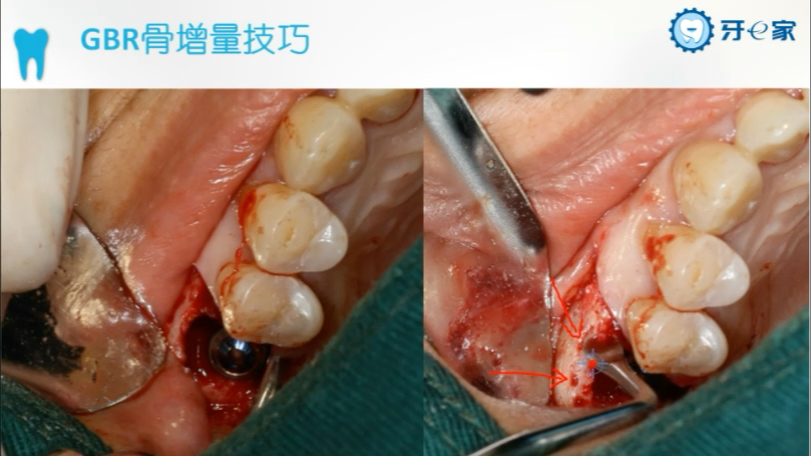 种植新人启航系列课《GBR引导骨再生术下》——冯楠