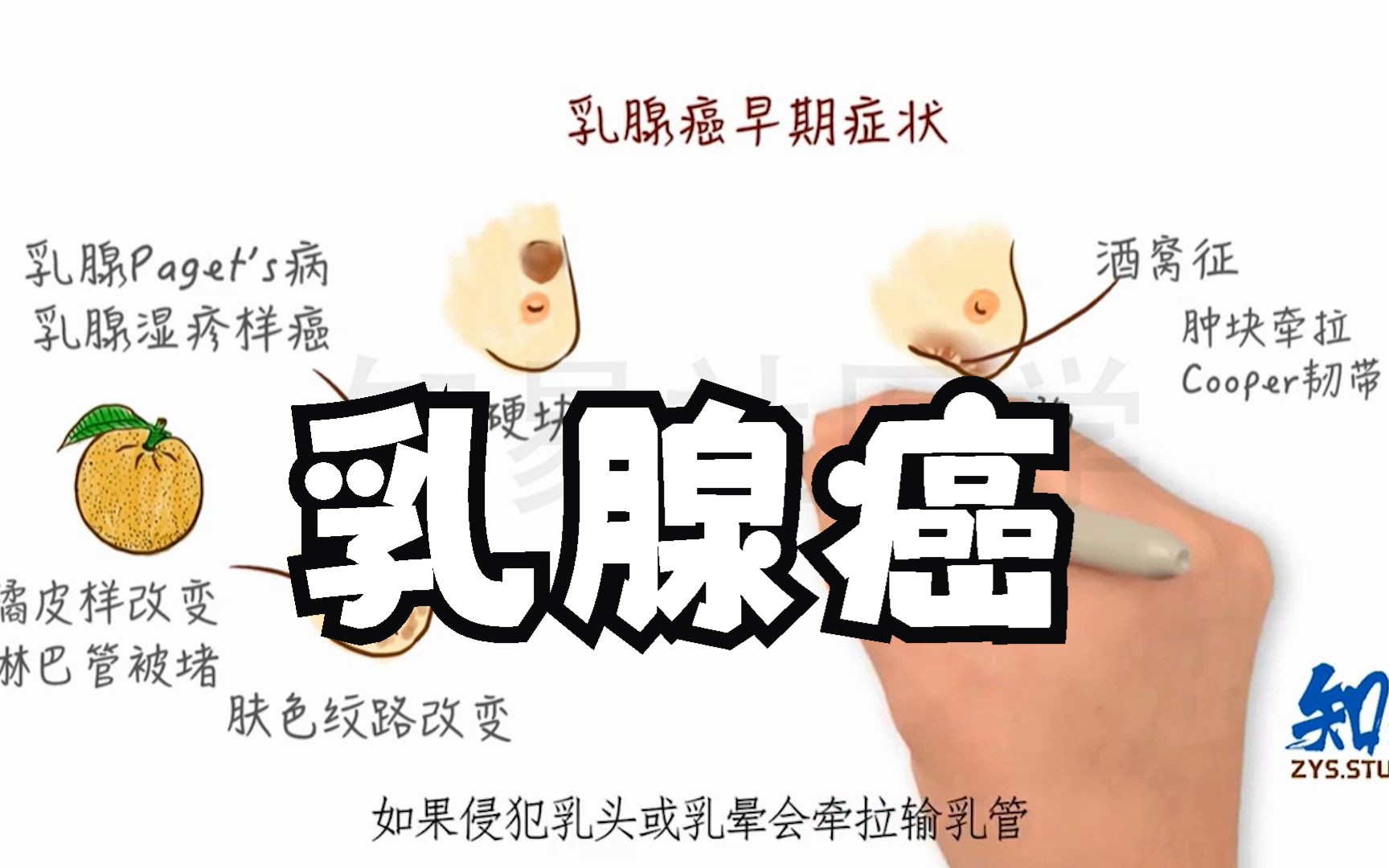 医学生动画演绎 乳腺癌
