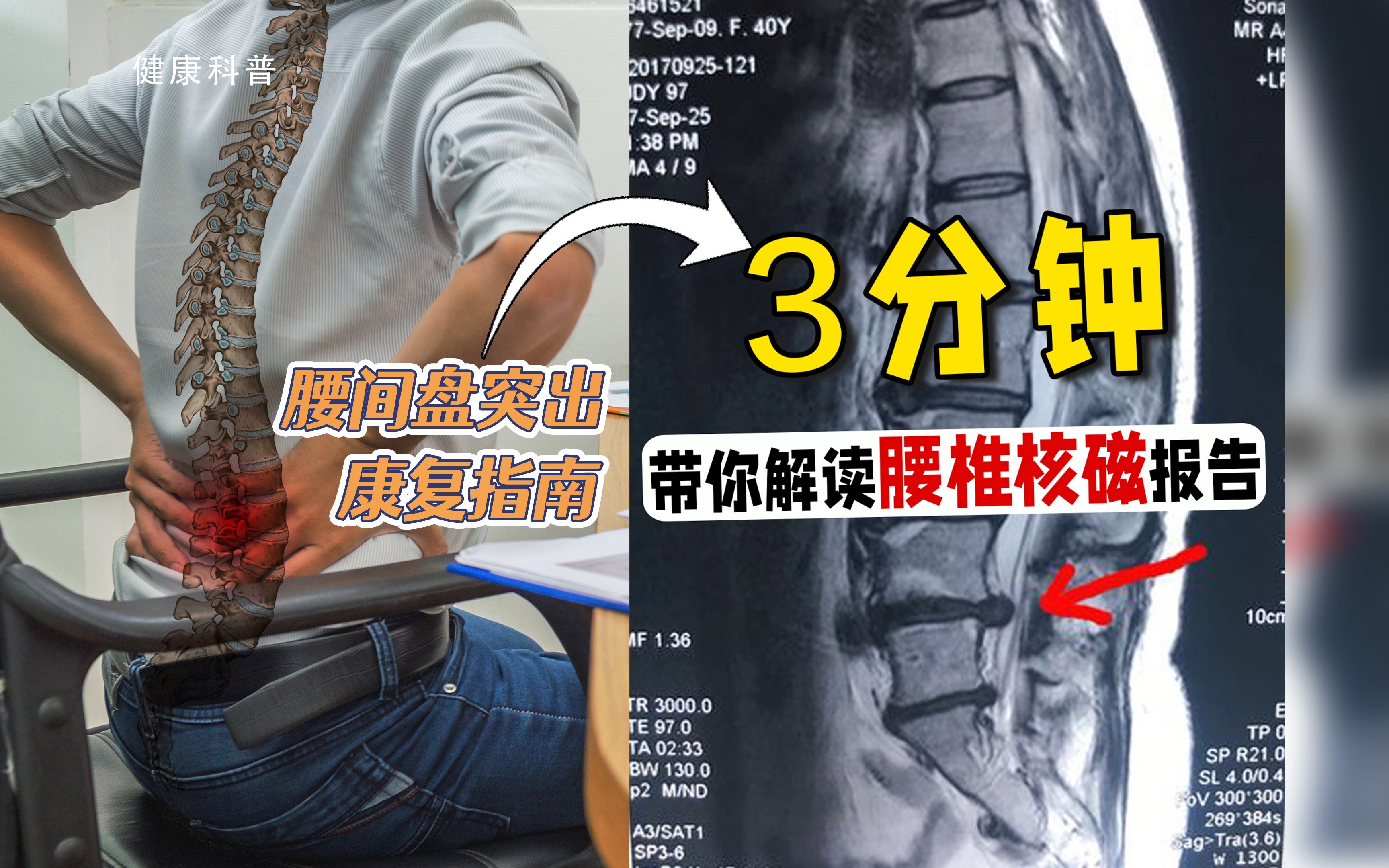 拍了片子看不懂?3分钟教你解读腰椎核磁报告,腰突的你必备科普