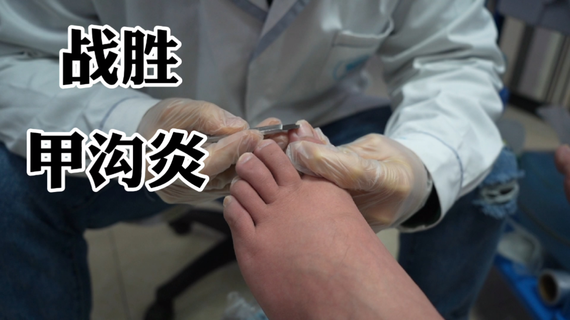 武汉粉丝坐动车过来修甲沟炎,给他解决