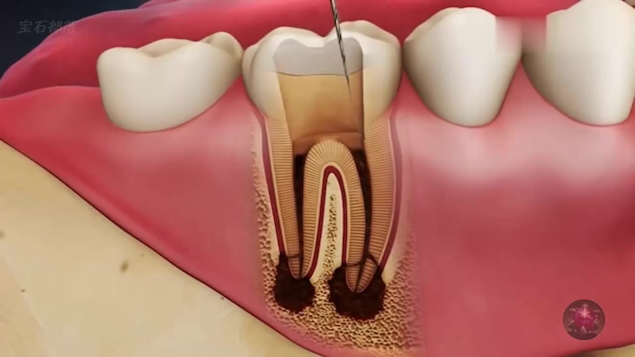 .不拔牙 2分钟动画看懂牙齿根管治疗