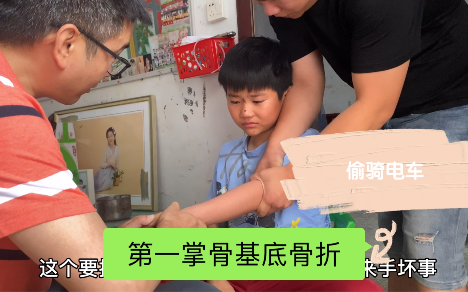 12岁小男孩偷骑电车摔跤,第一掌骨基底骨折,复位后用竹片固定