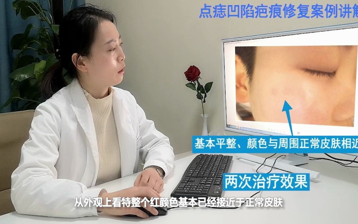 点痣造成的凹陷疤痕怎么修护效果才能又快又好?