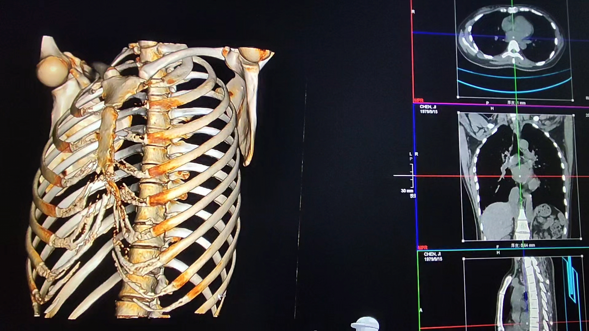 CT横断图上如何数肋骨。没有技术含量,纯粹水视频,大家多包涵。