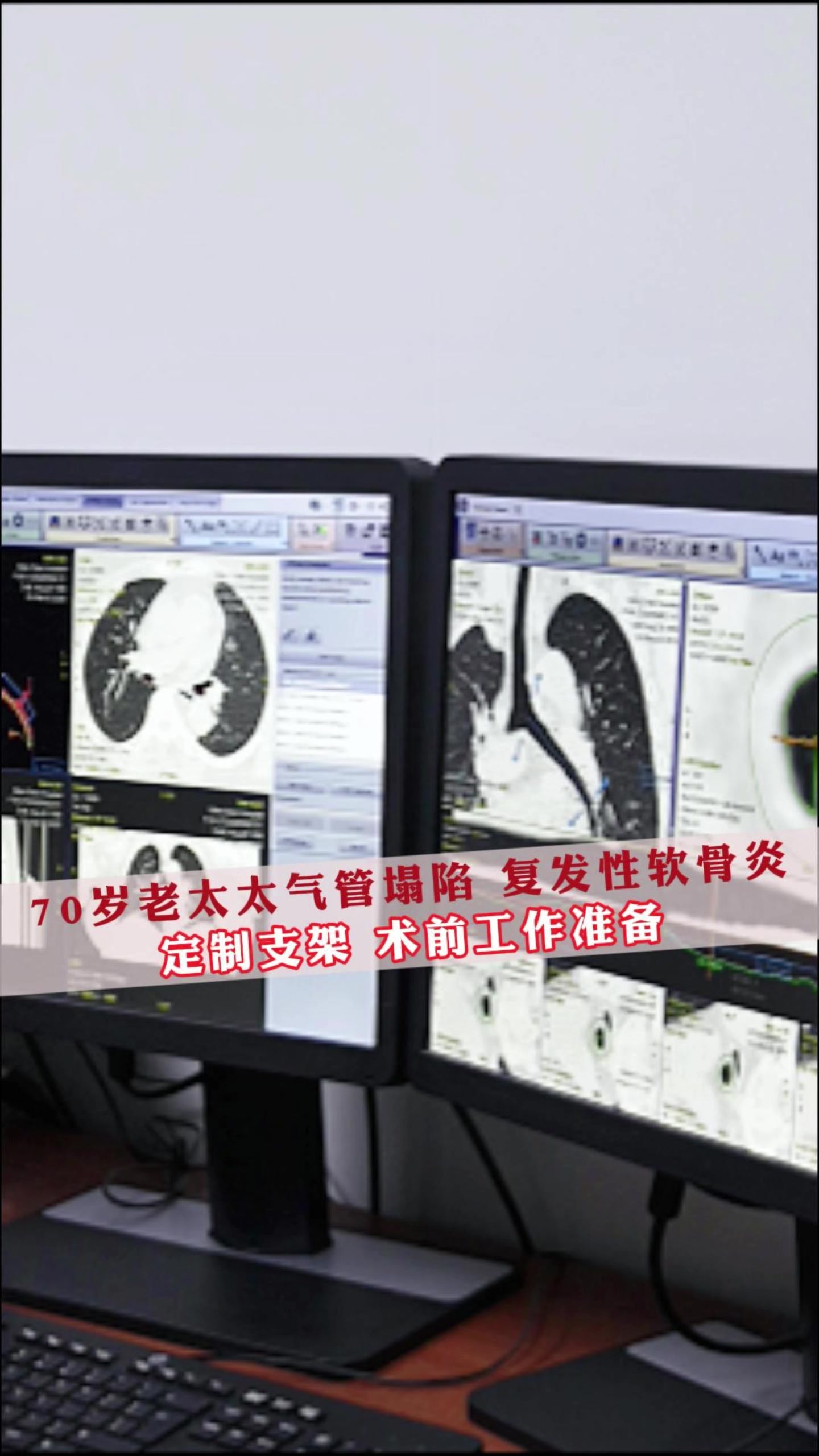 70岁老太太气管塌陷 复发性软骨炎定制支架 术前工作准备#气管 #高龄...