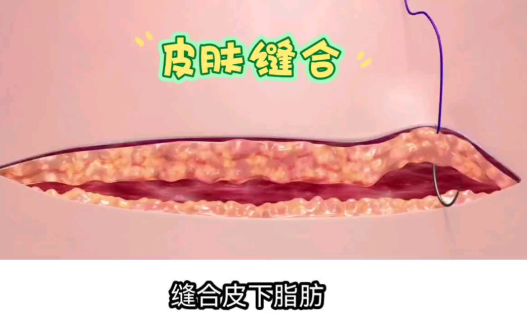 皮肤缝合:间断缝合+皮下连续缝合
