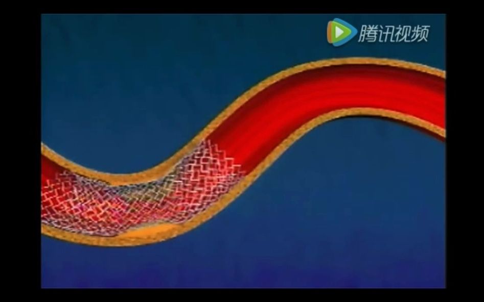 劲动脉狭窄支架手术视频