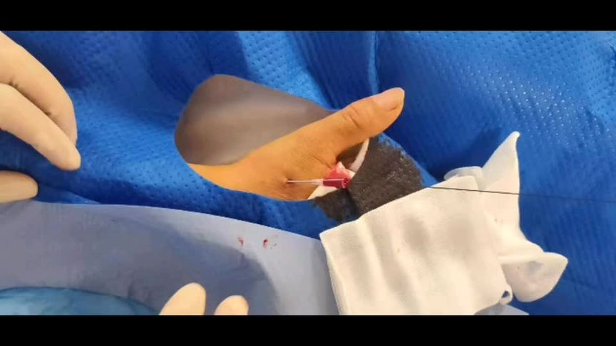 #扎针 #介入 #桡动脉穿刺 #医学生