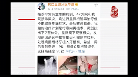 跟着彭彬老师学习显微镜根管治疗第二集(髓腔穿孔修补技巧)