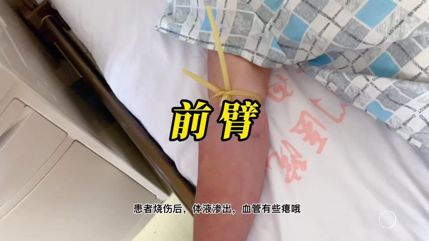 留置针穿刺日常分享…前臂,体液丢失#留置针 #护士