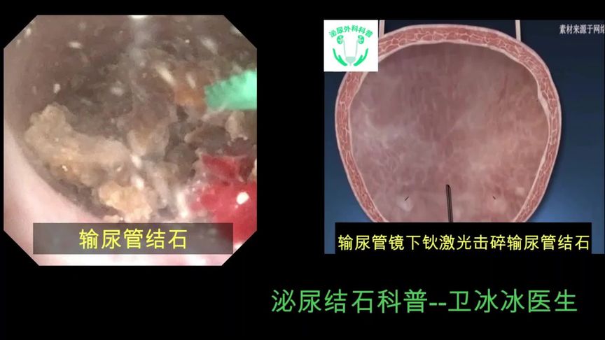 输尿管镜钬激光碎石术治疗肾结石和输尿管结石##医学科普