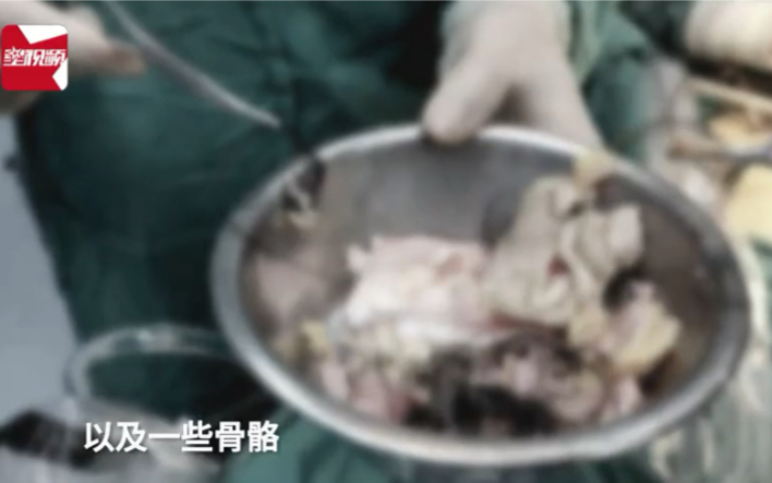 女子体检时发现体内有肿块,医生手术切开后发现大量头发和牙齿