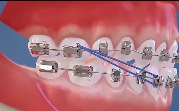 传统矫正 传统正畸全过程
