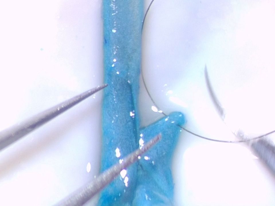 端侧+间断+腔外-左手+右手-1mm血管显微吻合练习#73-20240219
