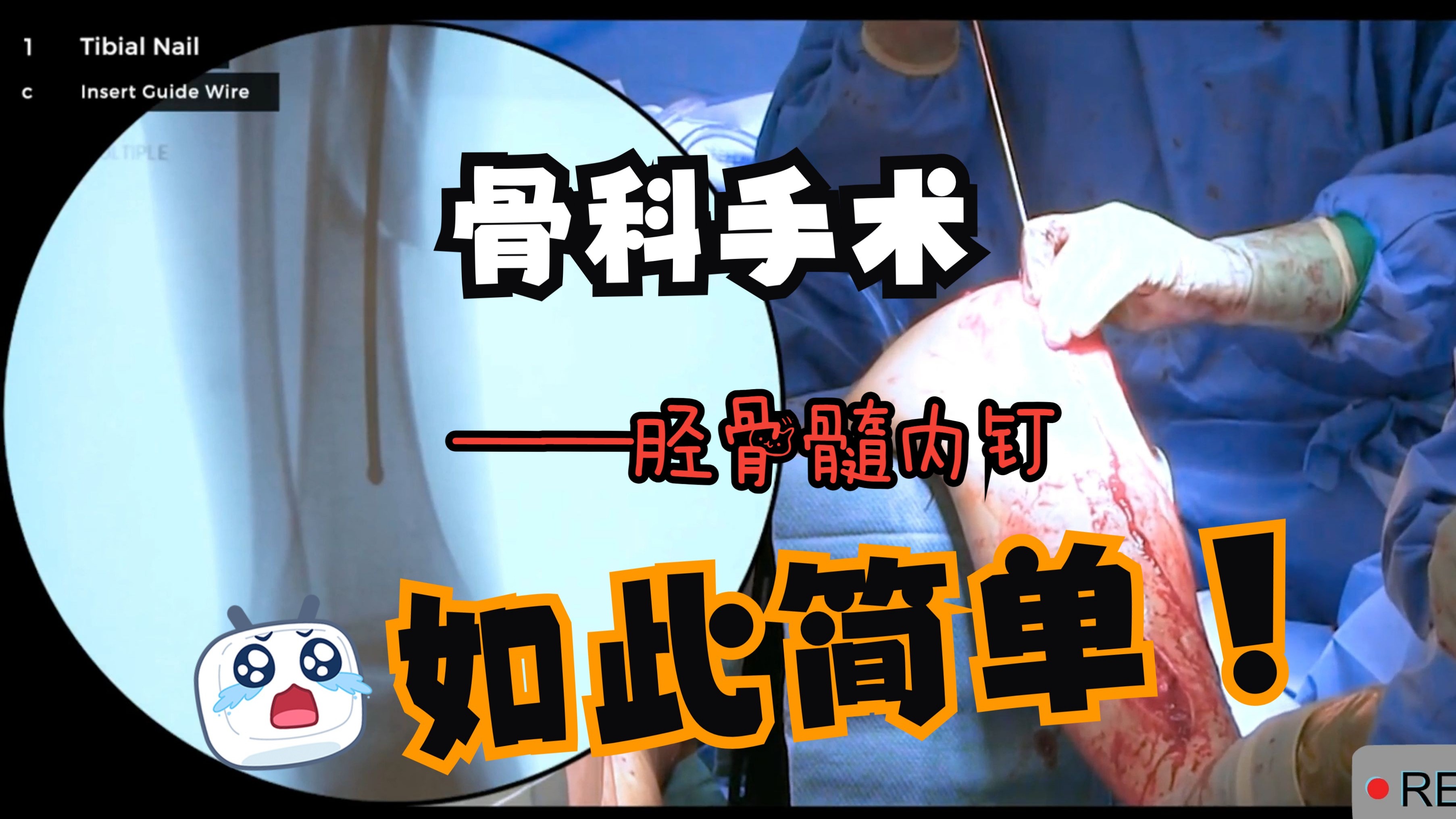 【4K骨科手术视频教学】开放性胫骨骨折髓内钉固定全流程 | 实时高清...