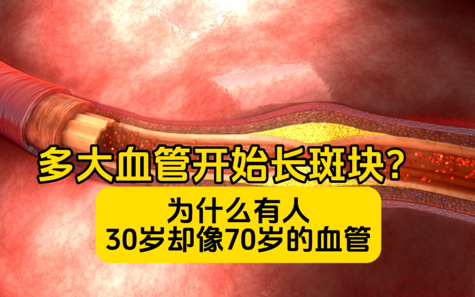 年龄多大血管开始长斑块?为什么有人30岁却像70岁的血管?