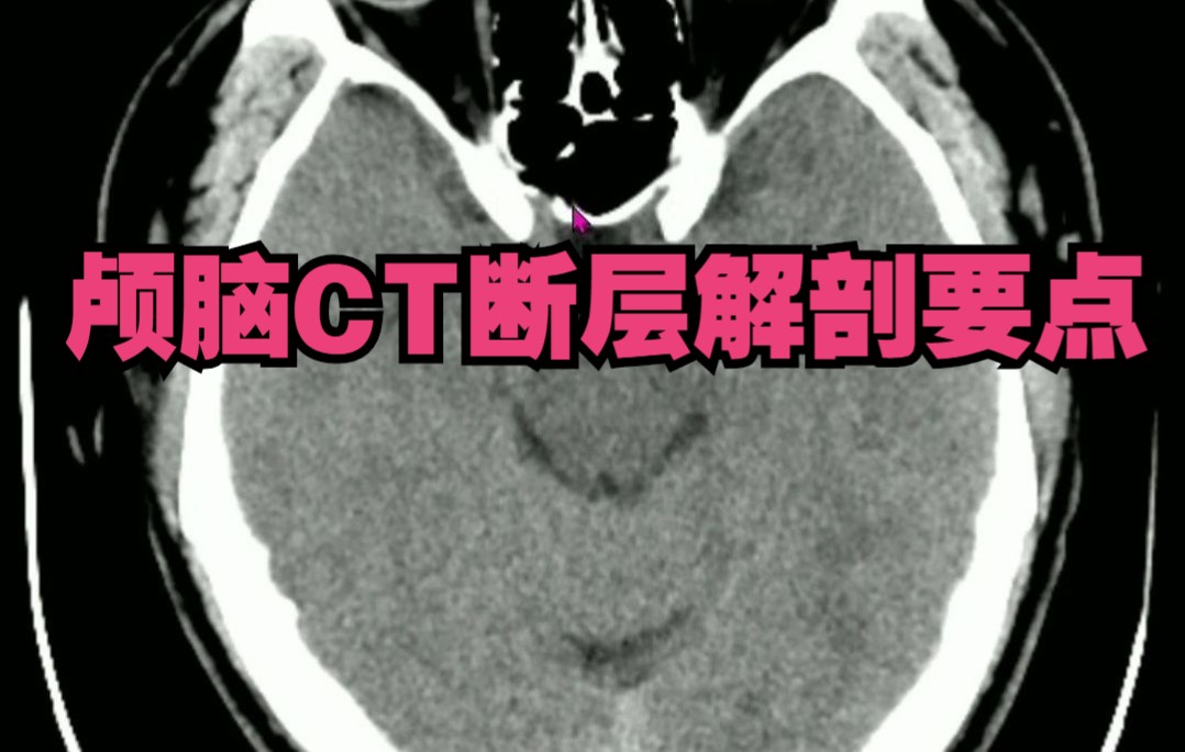 颅脑CT断层解剖基础,3分钟认识颅脑CT关键解剖位置。