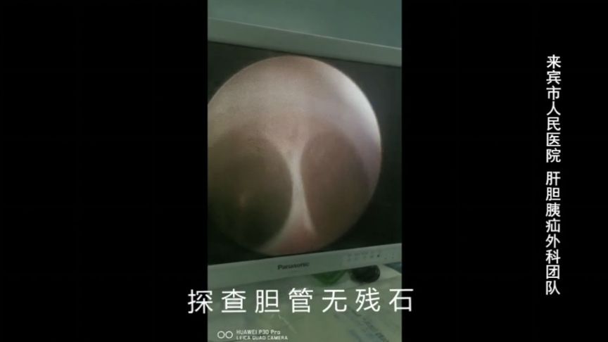 硬质胆道镜的LTCBDE,无需放置T管,微创效果更进一步