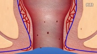 治痔疮不手术,有痔疮看视频