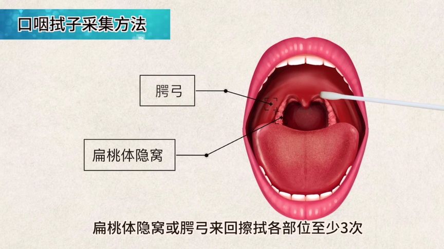 新型冠状病毒核酸检测-口咽拭子采集流程视频