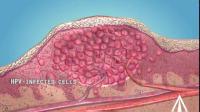3D医学动画:皮肤疣-Skin Warts