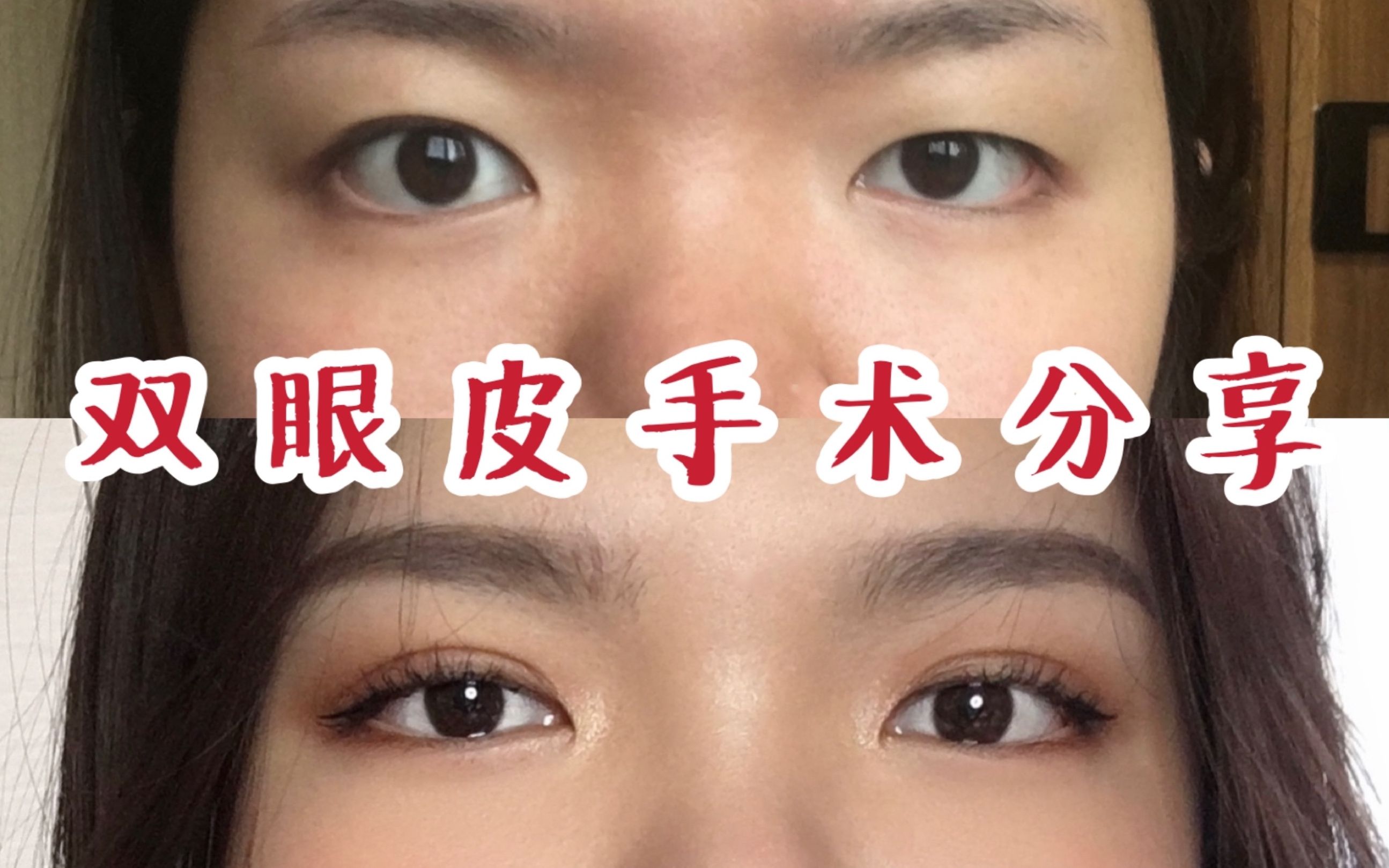 【胖虎】大小眼矫正/ 双眼皮手术分享/ 3个月恢复全记录/ 内含2个视频