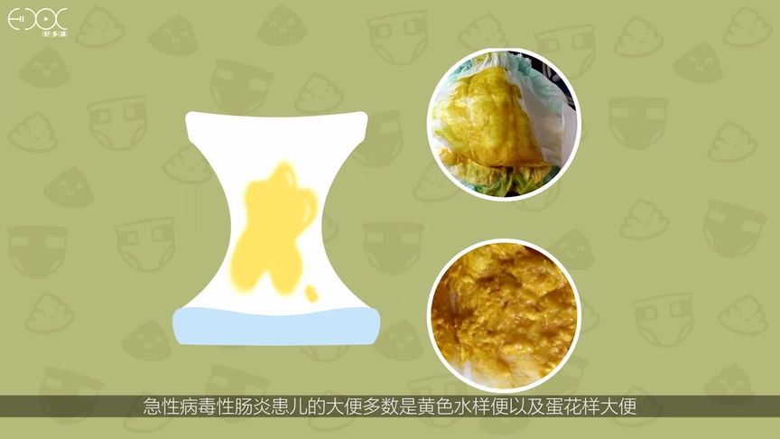 孩子有这些表现说明得了病毒性肠炎