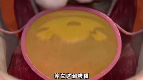 每天憋尿的后果有多可怕?他的膀胱竟然炸了!