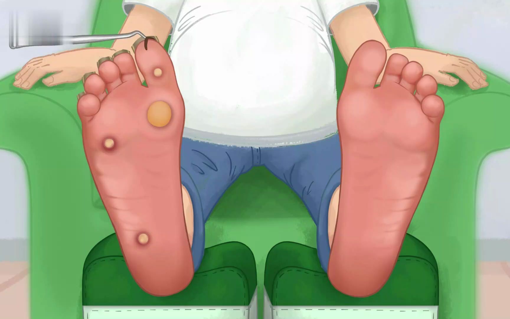 【沉浸式修脚】动画! 足疣治疗,脚趾甲护理,除厚厚的死皮细胞