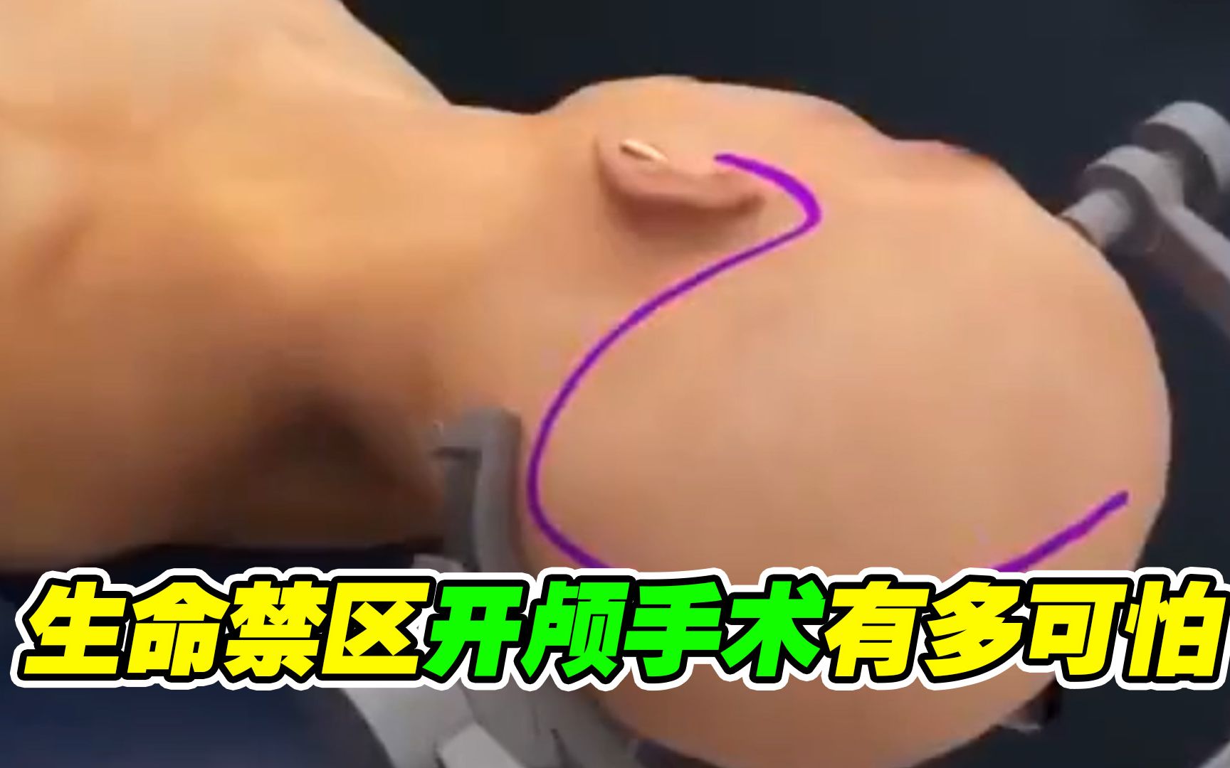 生命禁区开颅手术全过程,任何一步都不能出错,3D动画演示