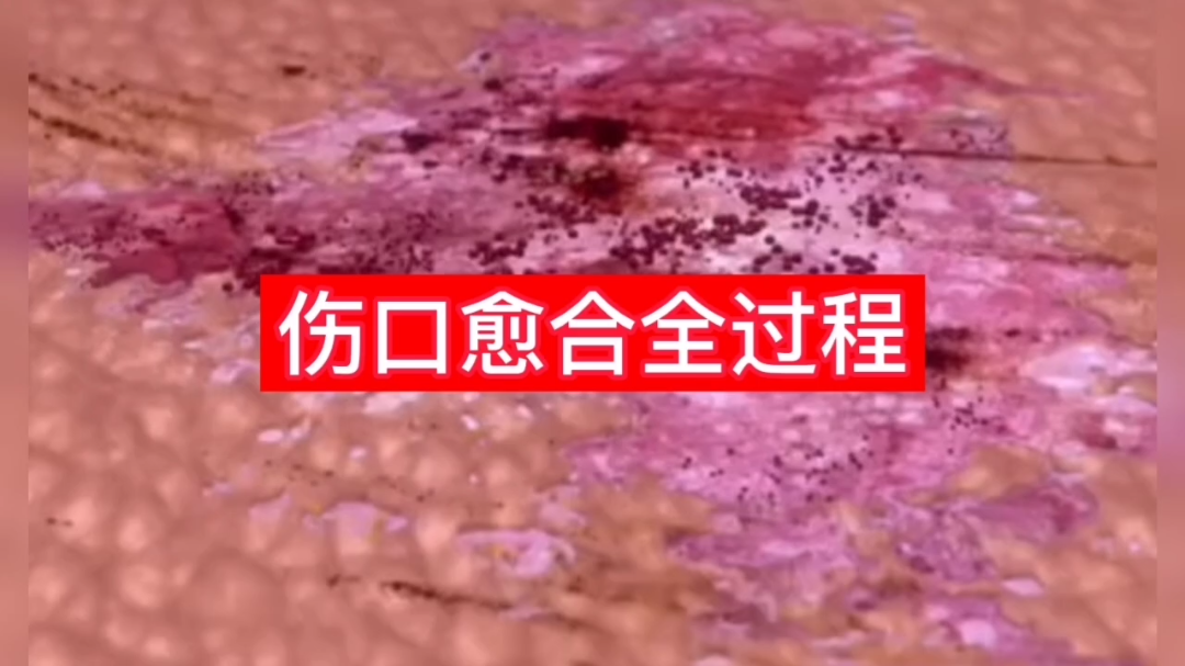从伤口愈合全过程,看免疫细胞的作用!#免