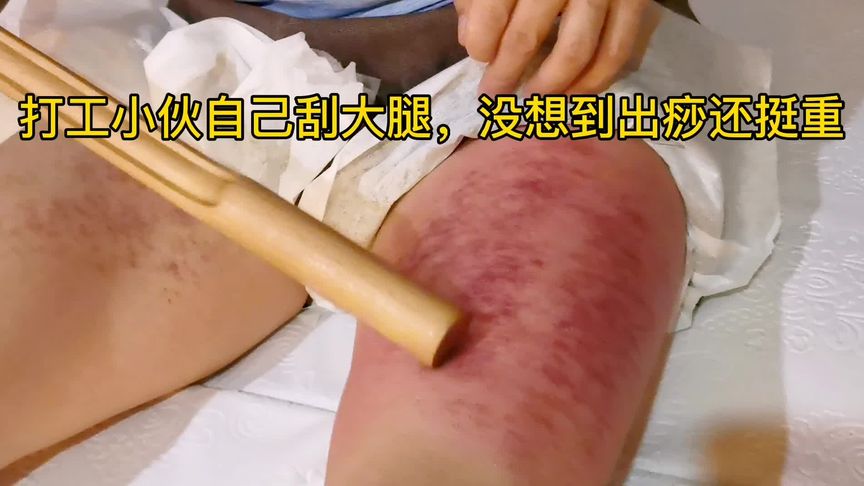 擀筋棒刮刮大腿,刮出大泡,自己操作真方便