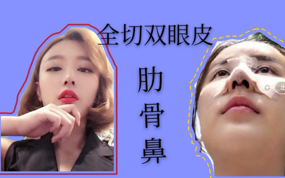 人生最后悔的整容手术!6w?7w?值得吗?后悔没有早点来!