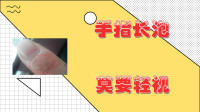 你体内的湿气有多重?从手上就能看出来,3个特征万万不能再拖