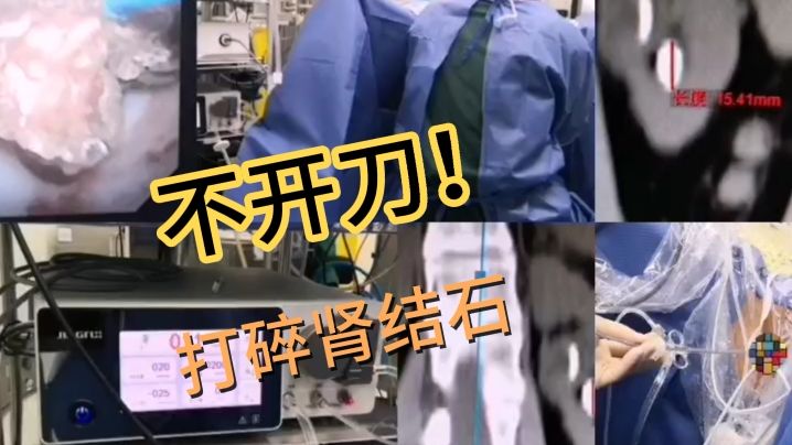 输尿管软镜将肾内结石打成粉末化