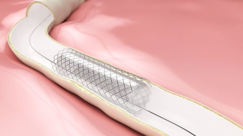 动脉粥样硬化怎样预防性治疗?